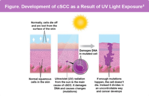 What is cSCC? – Catalyst Regeneron